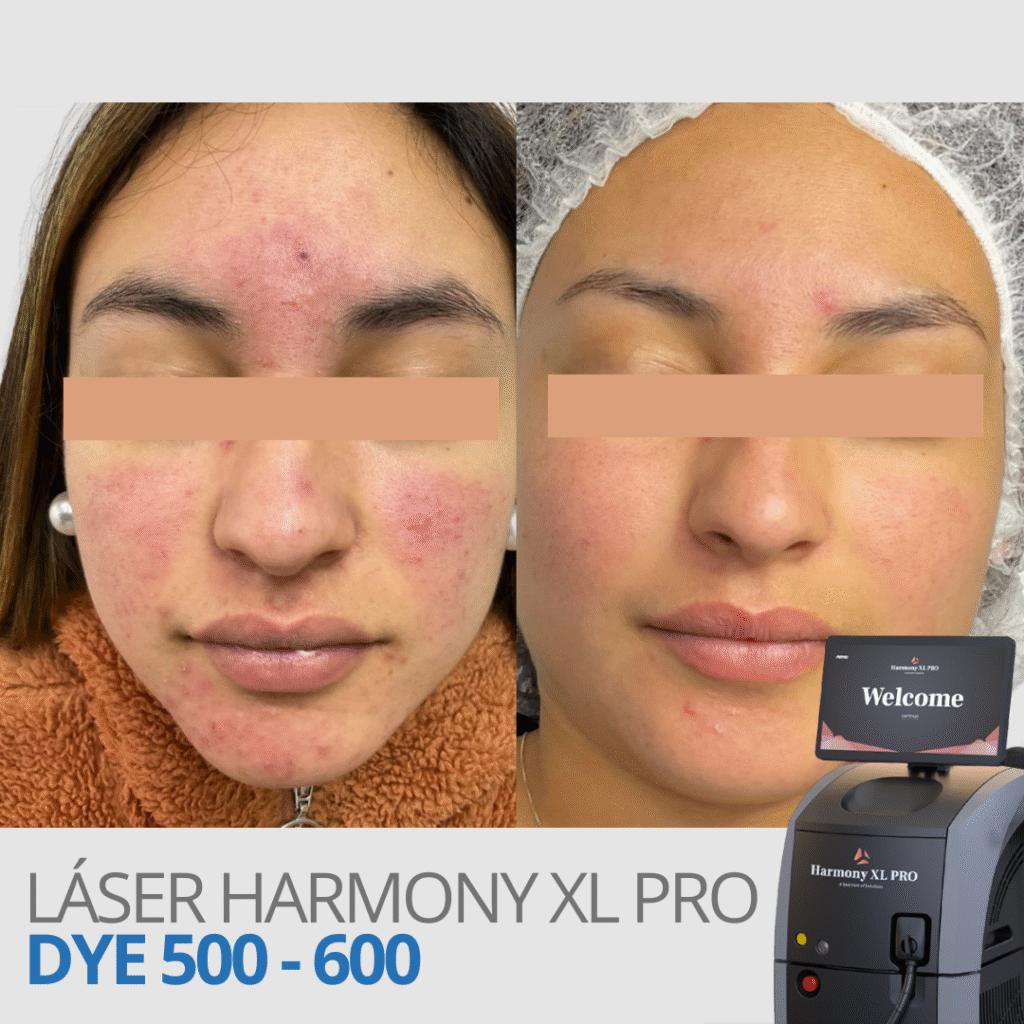 Láser Harmony XL Pro DYE 500 – 600